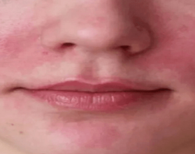 دواعي استعمال كريم ديكسبانثينول Dexpanthenol للحساسية والآثار الجانبية ...