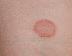 دواعي استعمال كريم ديكسبانثينول Dexpanthenol للحساسية والآثار الجانبية ...