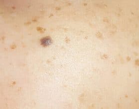 دواعي استعمال كريم ديكسبانثينول Dexpanthenol للحساسية والآثار الجانبية ...